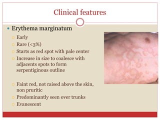 Acute rheumatic fever | PPTX
