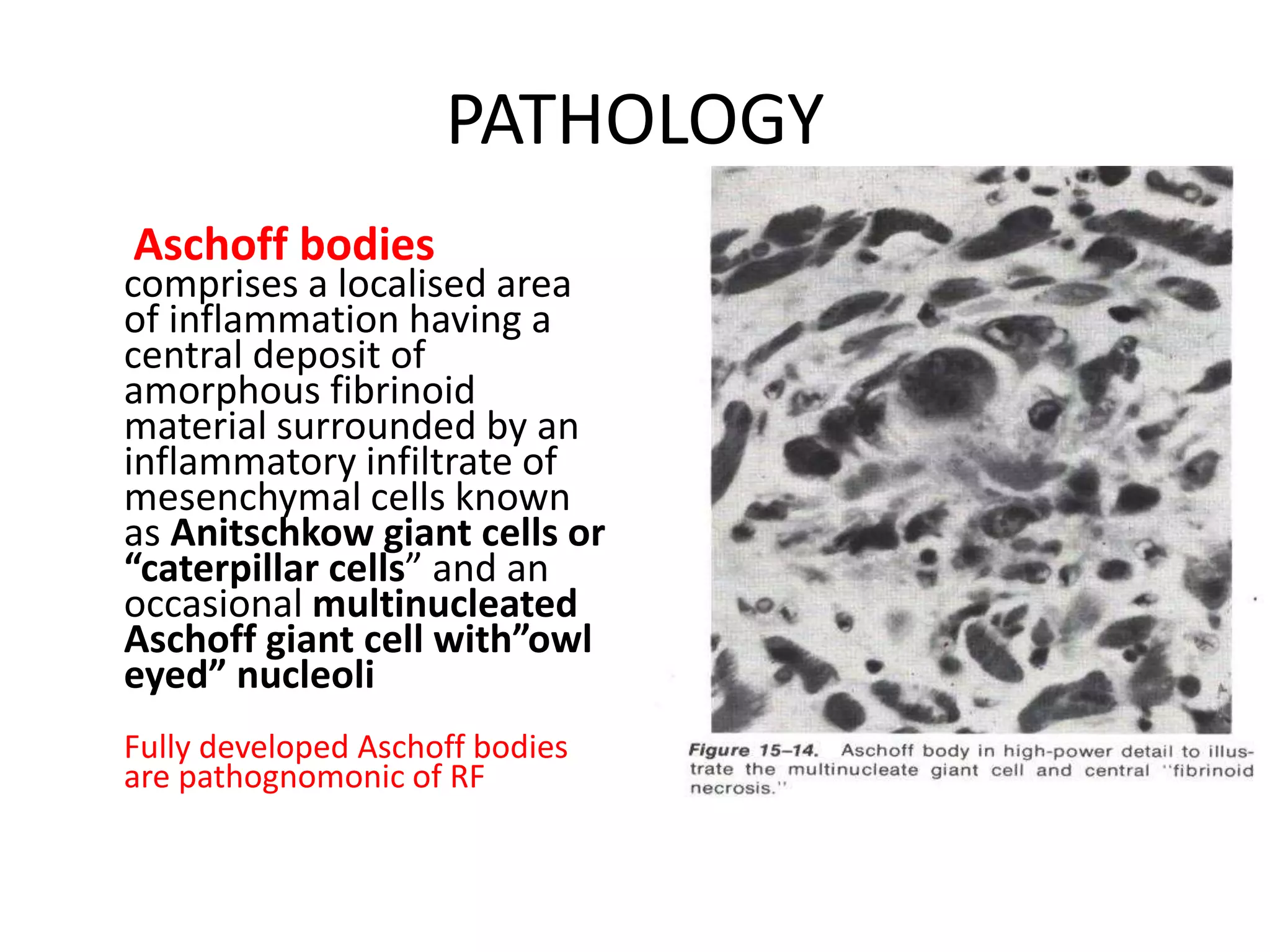 Acute rheumatic fever | PPTX