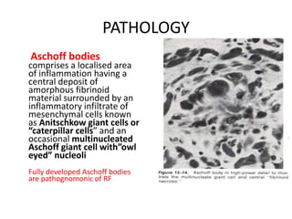 Acute rheumatic fever | PPT