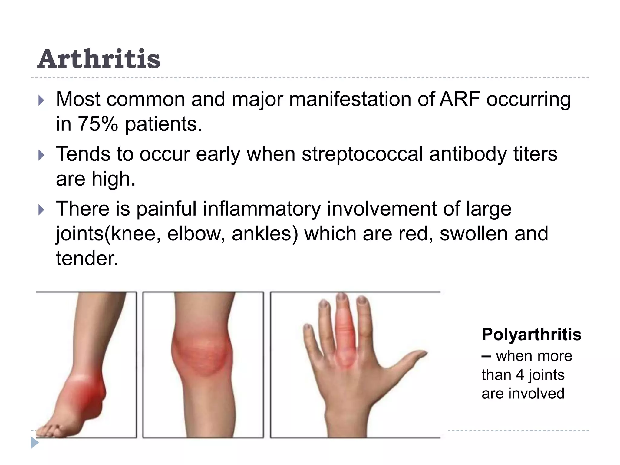 Acute rheumatic fever/ Rheumatic Fever | PPTX
