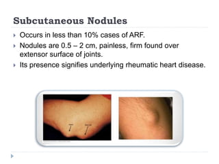 Acute rheumatic fever/ Rheumatic Fever | PPTX