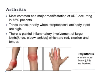 Acute rheumatic fever/ Rheumatic Fever | PPTX