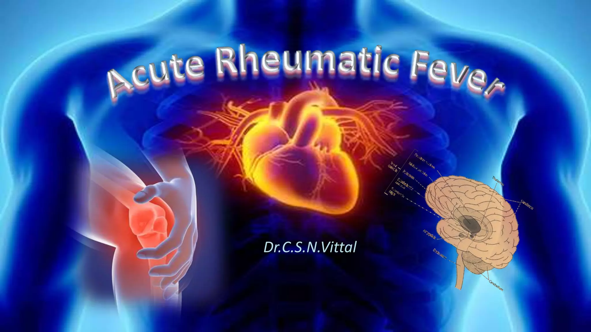 Acute rheumatic fever in Children | PPTX