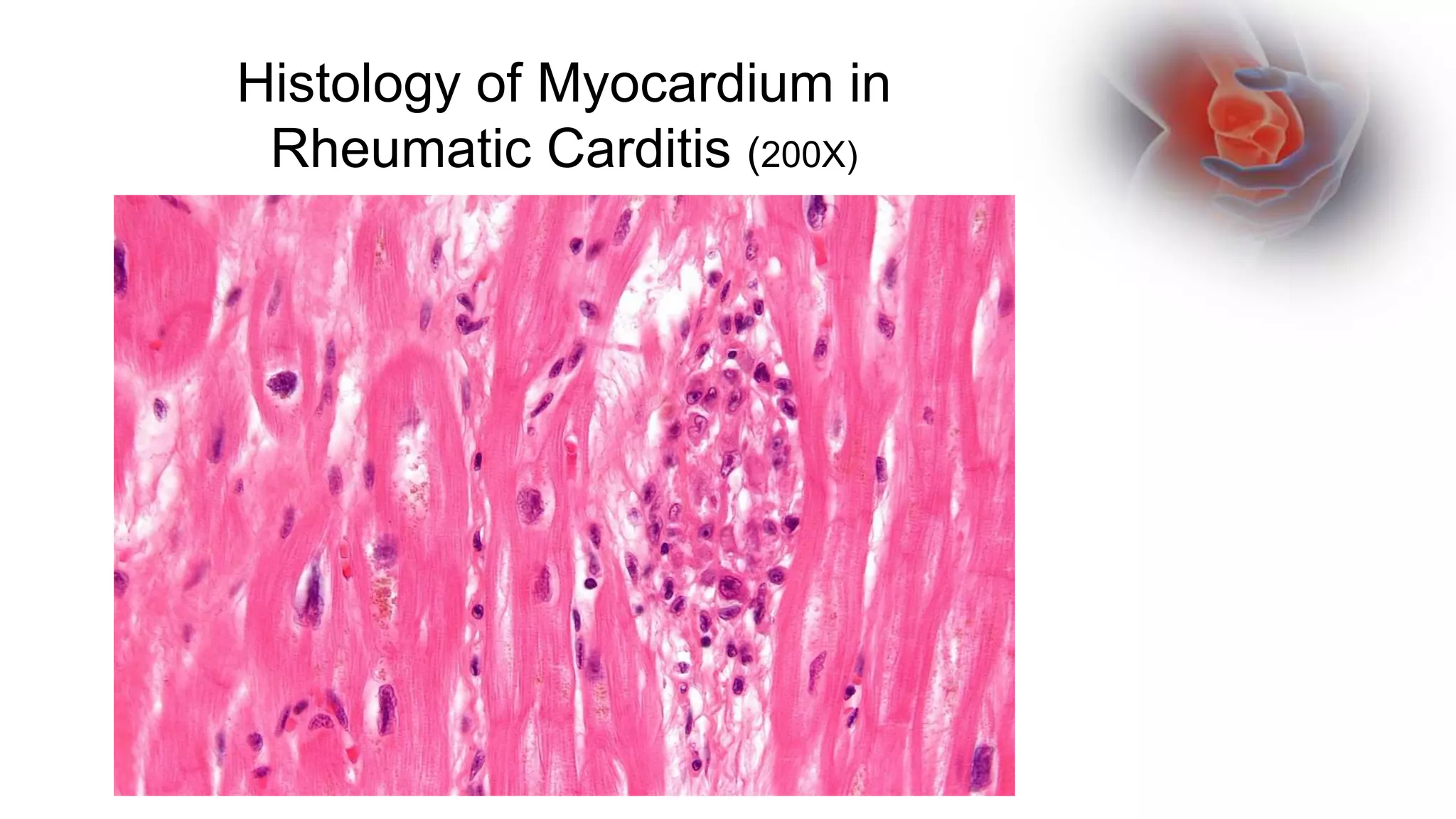 Acute rheumatic fever in Children | PPTX