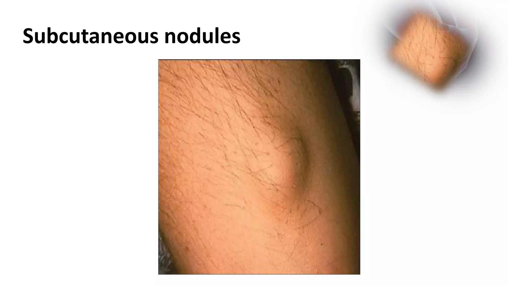 Acute rheumatic fever in Children | PPTX