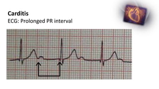 Acute rheumatic fever in Children | PPT