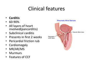 Acute Rheumatic Fever.pptx | Heart and Cardiovascular Diseases ...
