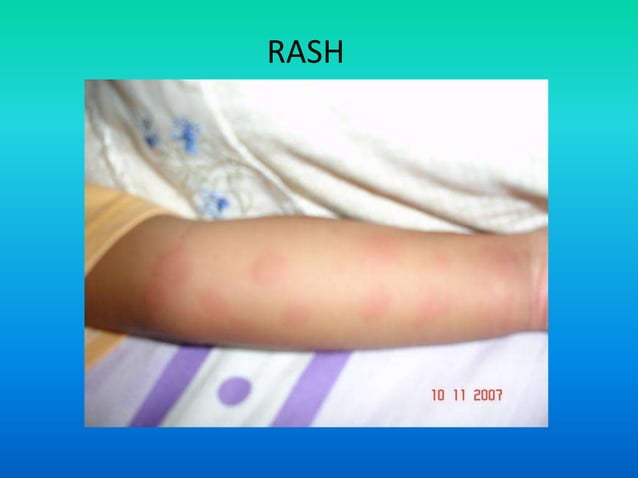 ACUTE RHEUMATIC FEVER.pptx