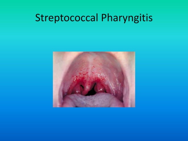 ACUTE RHEUMATIC FEVER.pptx