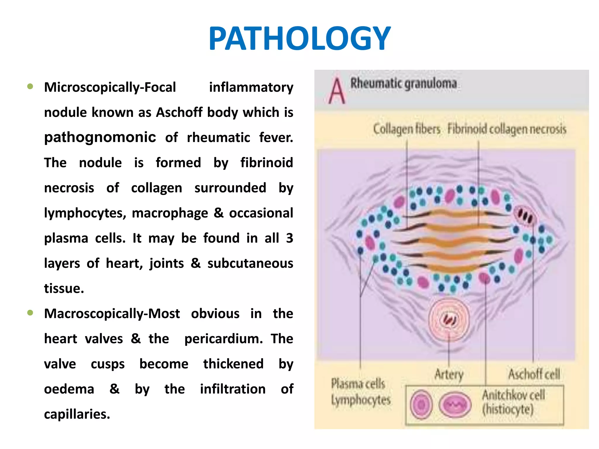 Acute Rheumatic Fever.ppt