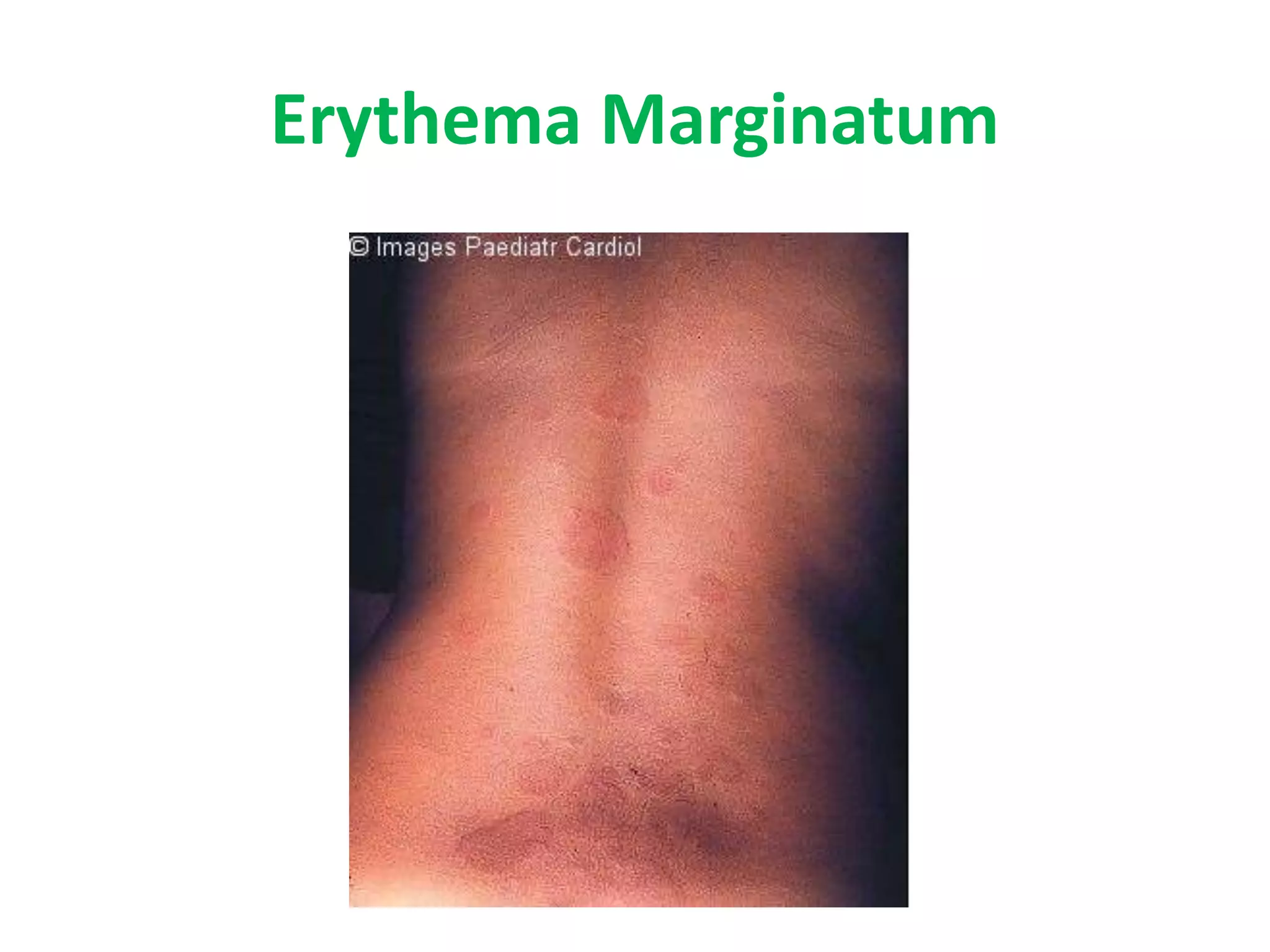 Acute Rheumatic Fever.ppt