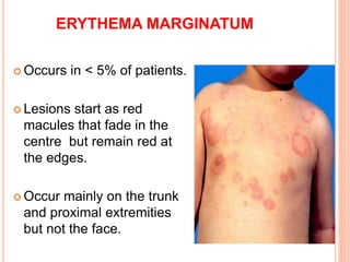 Acute rheumatic fever | PDF