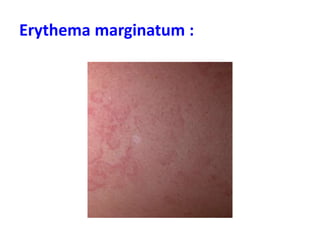 Erythema Marginatum Rheumatic Fever