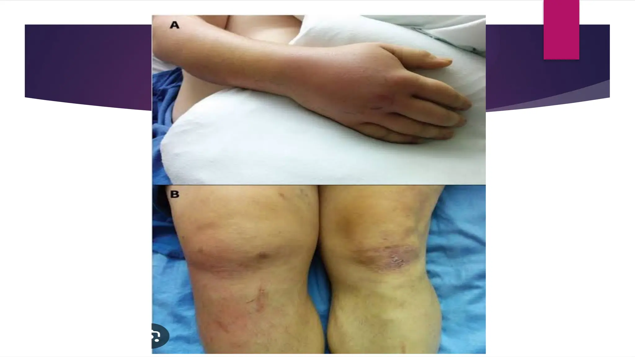 New streptococcus Acute Rheumatic Fever new.pptx