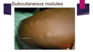 New streptococcus Acute Rheumatic Fever new.pptx