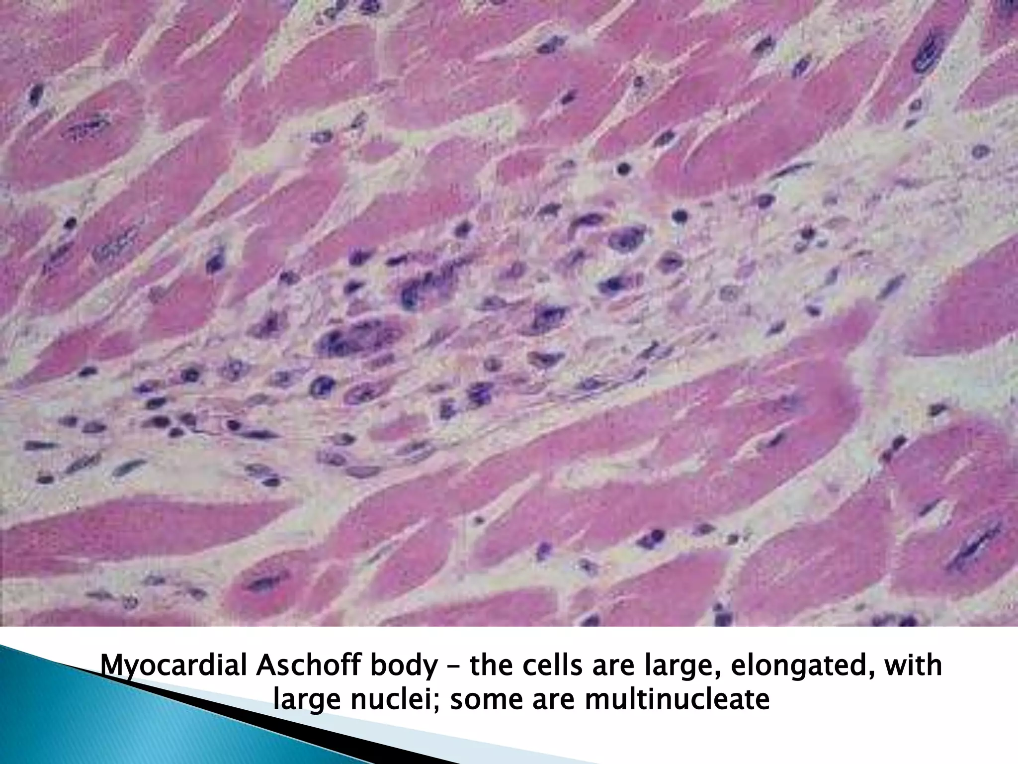 Acute Rheumatic Fever | PPTX