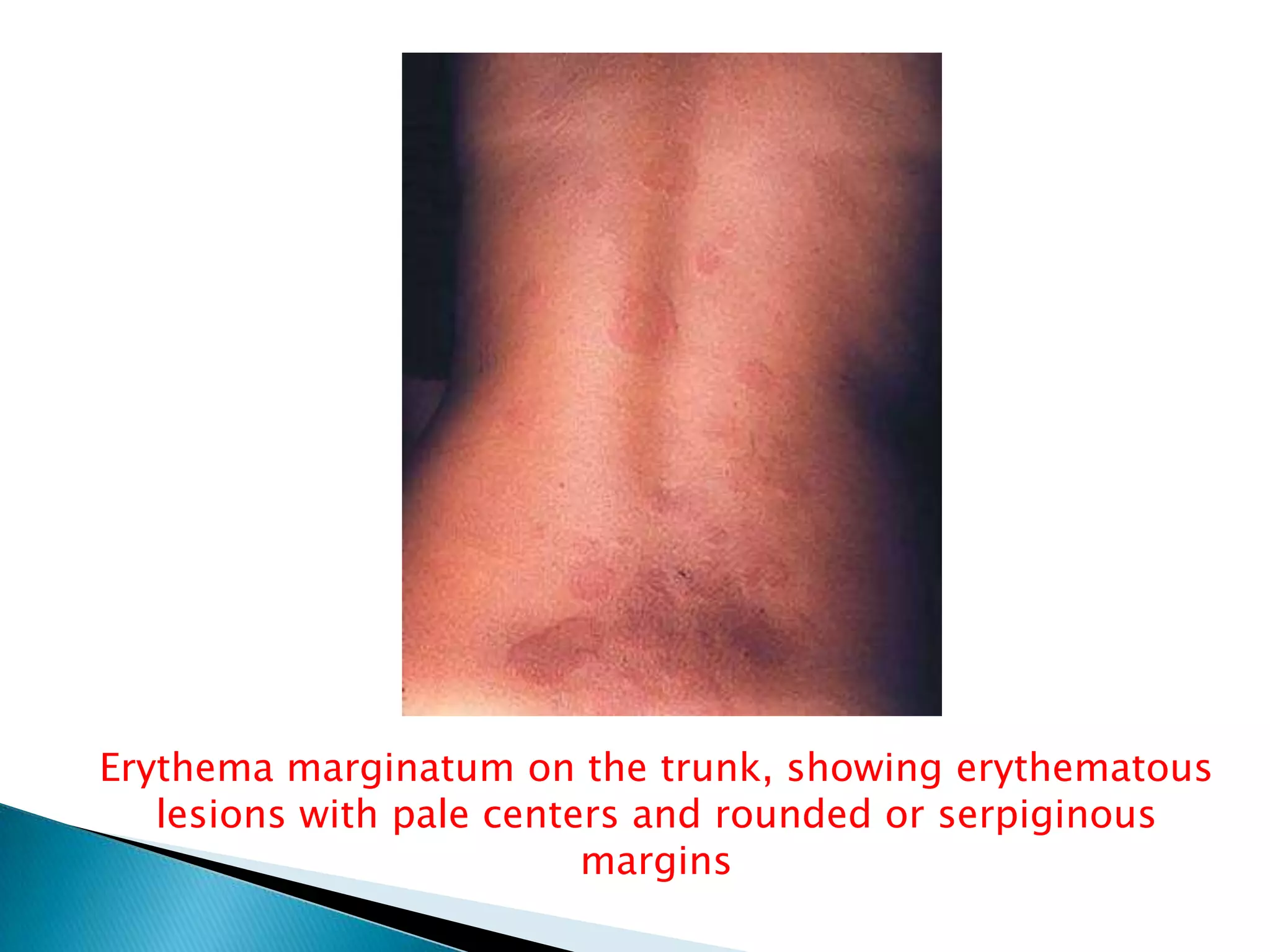 Acute Rheumatic Fever | PPTX