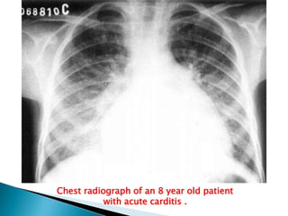 Acute Rheumatic Fever | PPTX