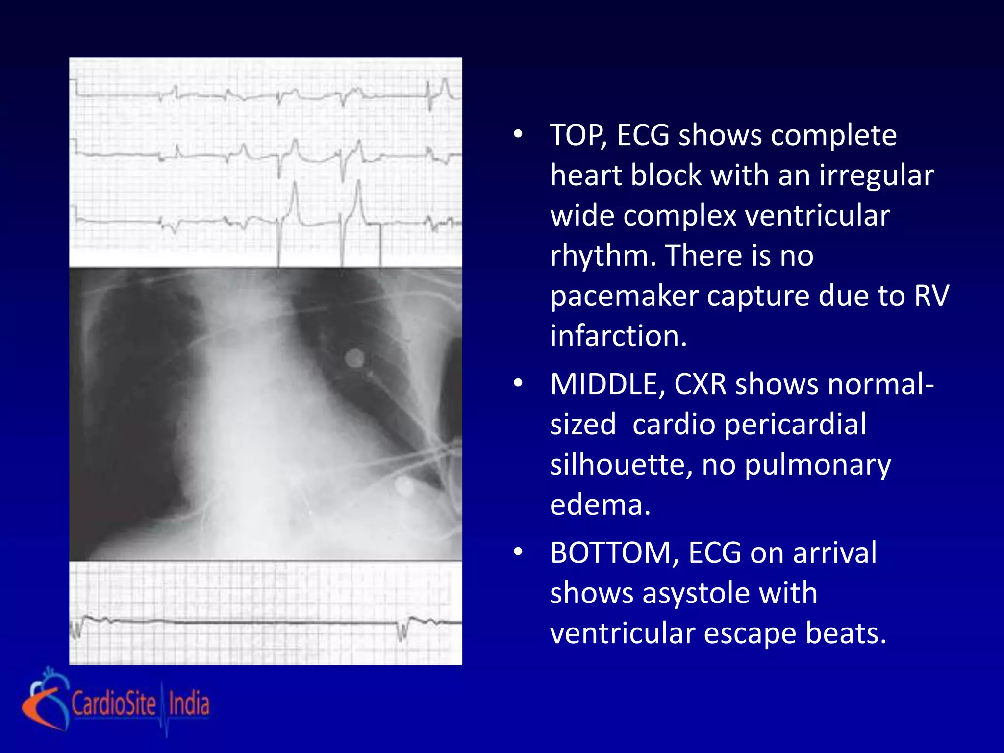 Acute rv failure physiology to management | PPT