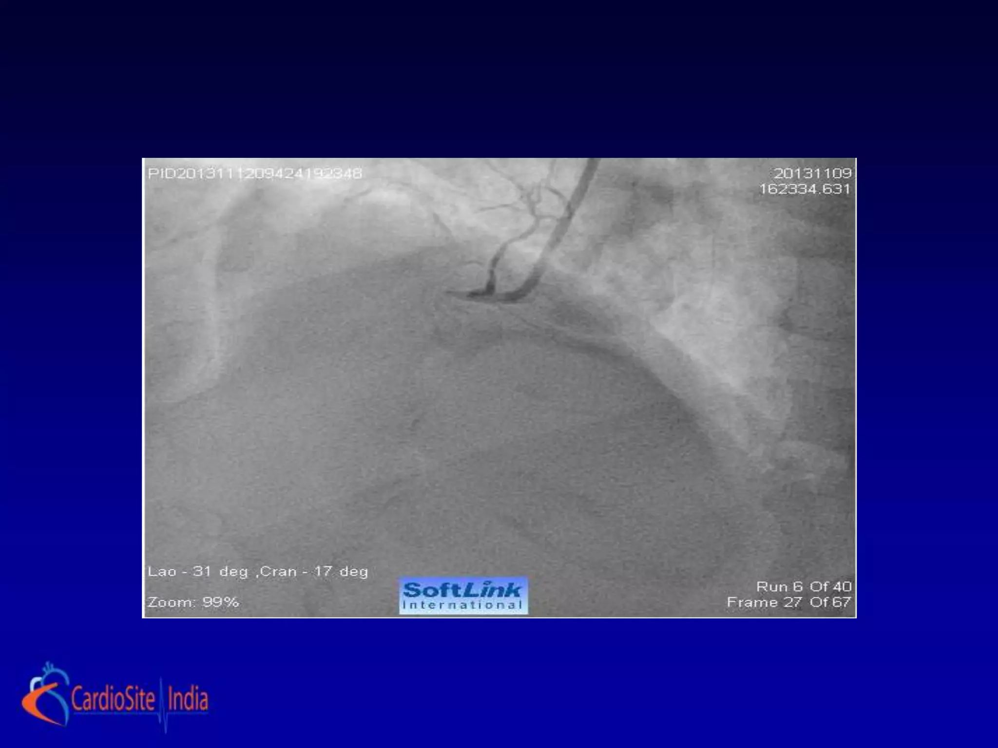 Acute rv failure physiology to management | PPT