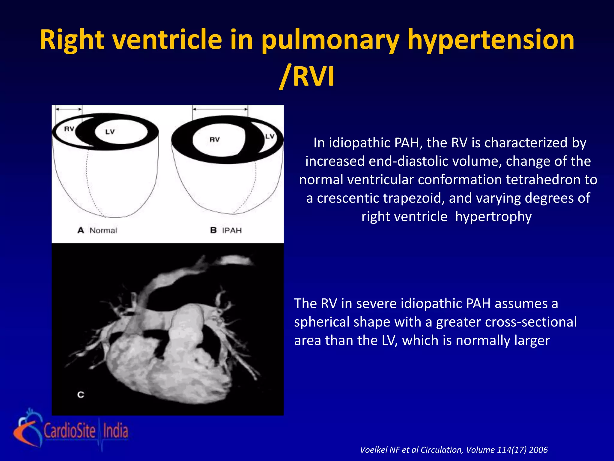 Acute rv failure physiology to management | PPT