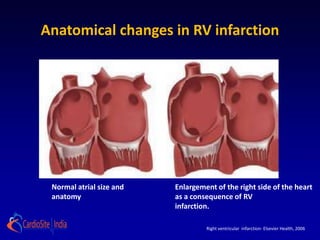 Acute rv failure physiology to management | PPT