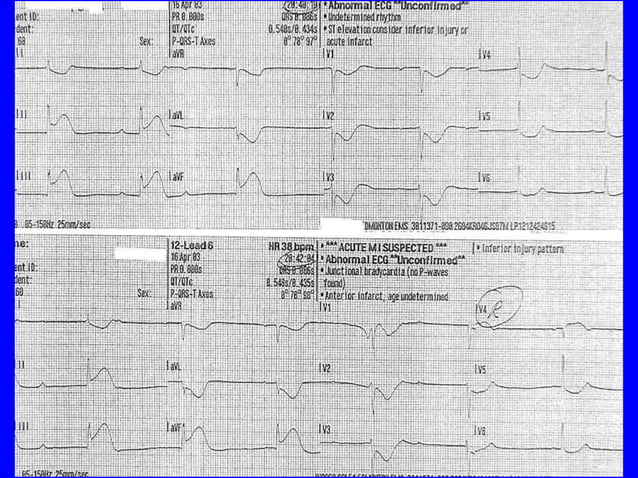Acute rv failure physiology to management | PPT