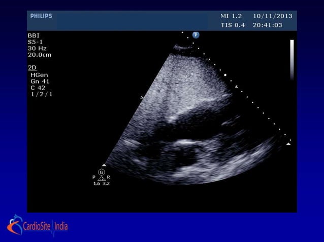 Acute rv failure physiology to management | PPT