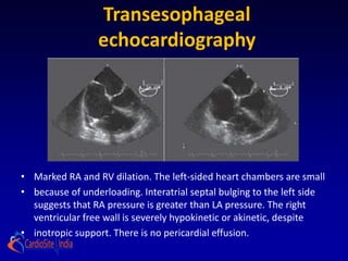 Acute rv failure physiology to management | PPT