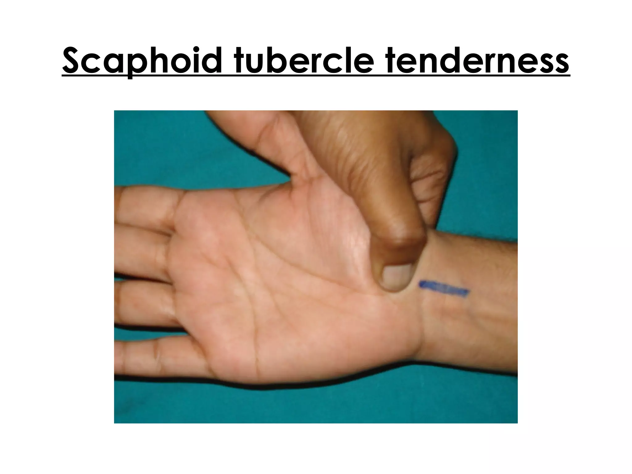 Acute scaphoid fractures | PPT
