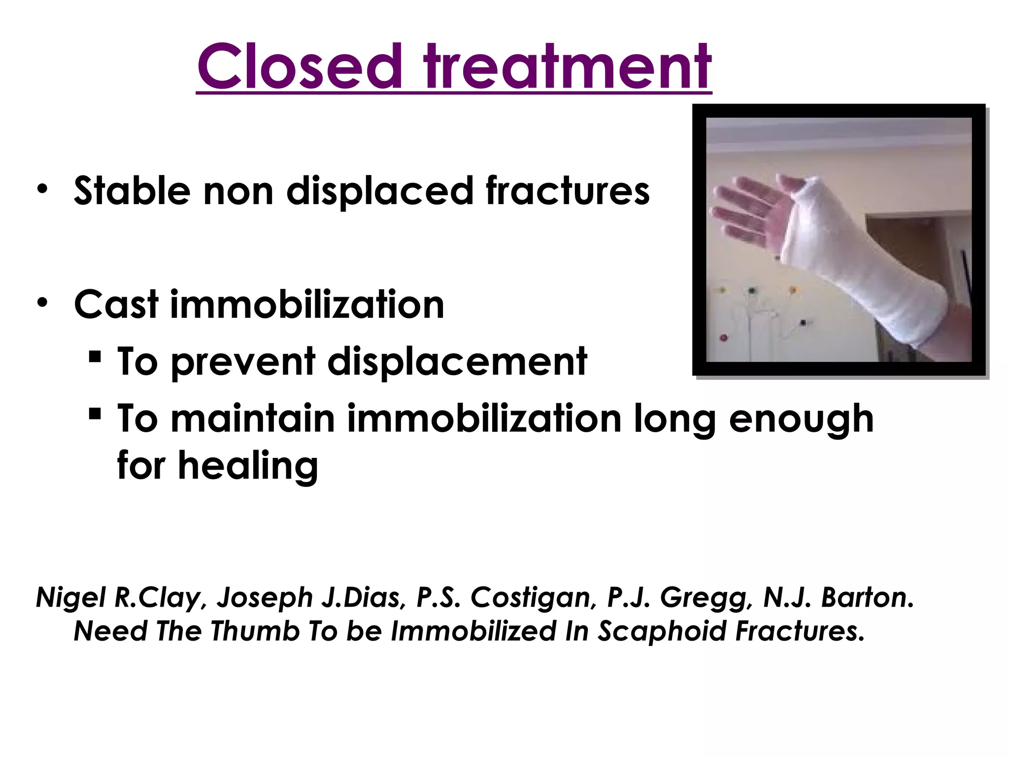 Acute scaphoid fractures | PPT
