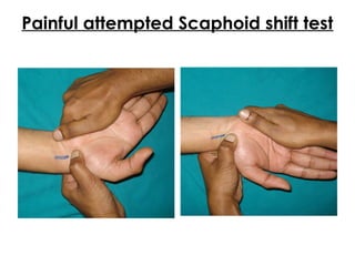 Acute scaphoid fractures | PPT