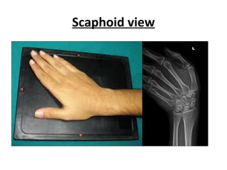 Acute scaphoid fractures | PPT
