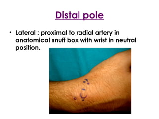 Acute scaphoid fractures | PPT