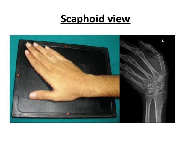 Acute scaphoid fractures