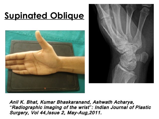 Acute scaphoid fractures