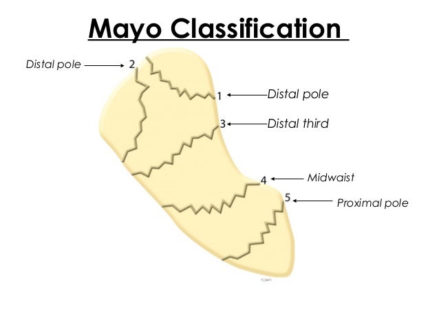 Acute scaphoid fractures