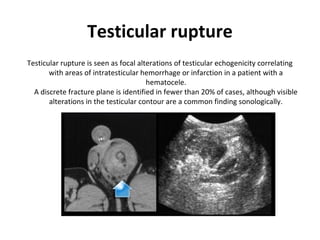 Acute scrotum | PPT