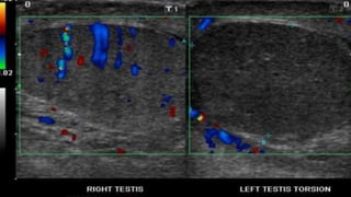 Acute scrotum | PPTX