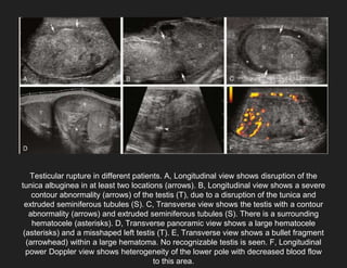 Acute scrotum (1).pptx