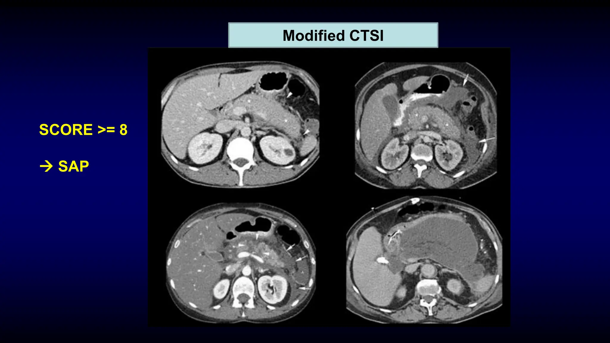 acute severe pancreatitis - its amnagement | PPTX