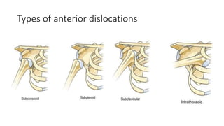 Acute shoulder dislocation | PPTX