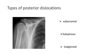 Acute shoulder dislocation | PPTX