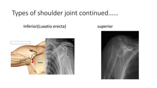Acute shoulder dislocation | PPTX