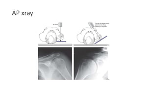 Acute shoulder dislocation | PPTX
