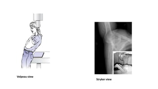 Acute shoulder dislocation | PPTX