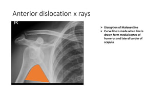 Acute shoulder dislocation | PPTX