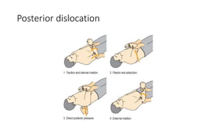 Acute shoulder dislocation | PPTX