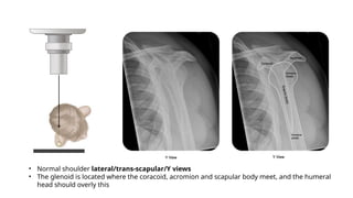 Acute Shoulder Dislocation (Traumatic Dislocation of the Glenohumeral ...