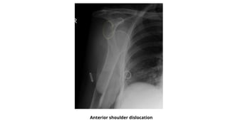 Acute Shoulder Dislocation (Traumatic Dislocation of the Glenohumeral ...
